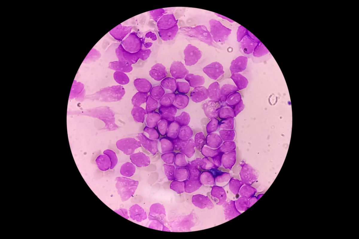 Possibili novità per la cura della leucemia acuta linfoblastica da ...